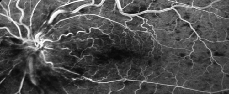 Is thrombosis of retinal veins a marker of occult cancer? - Icthic Magazine